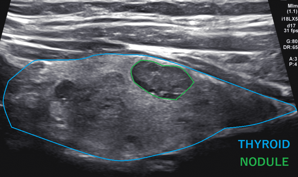 Thyroid Ultrasound Anchorage | Neck Ultrasound | Anchorage AK